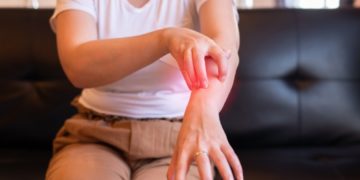 Podofilina antes e depois: para que serve? - Blog - Recover Farma